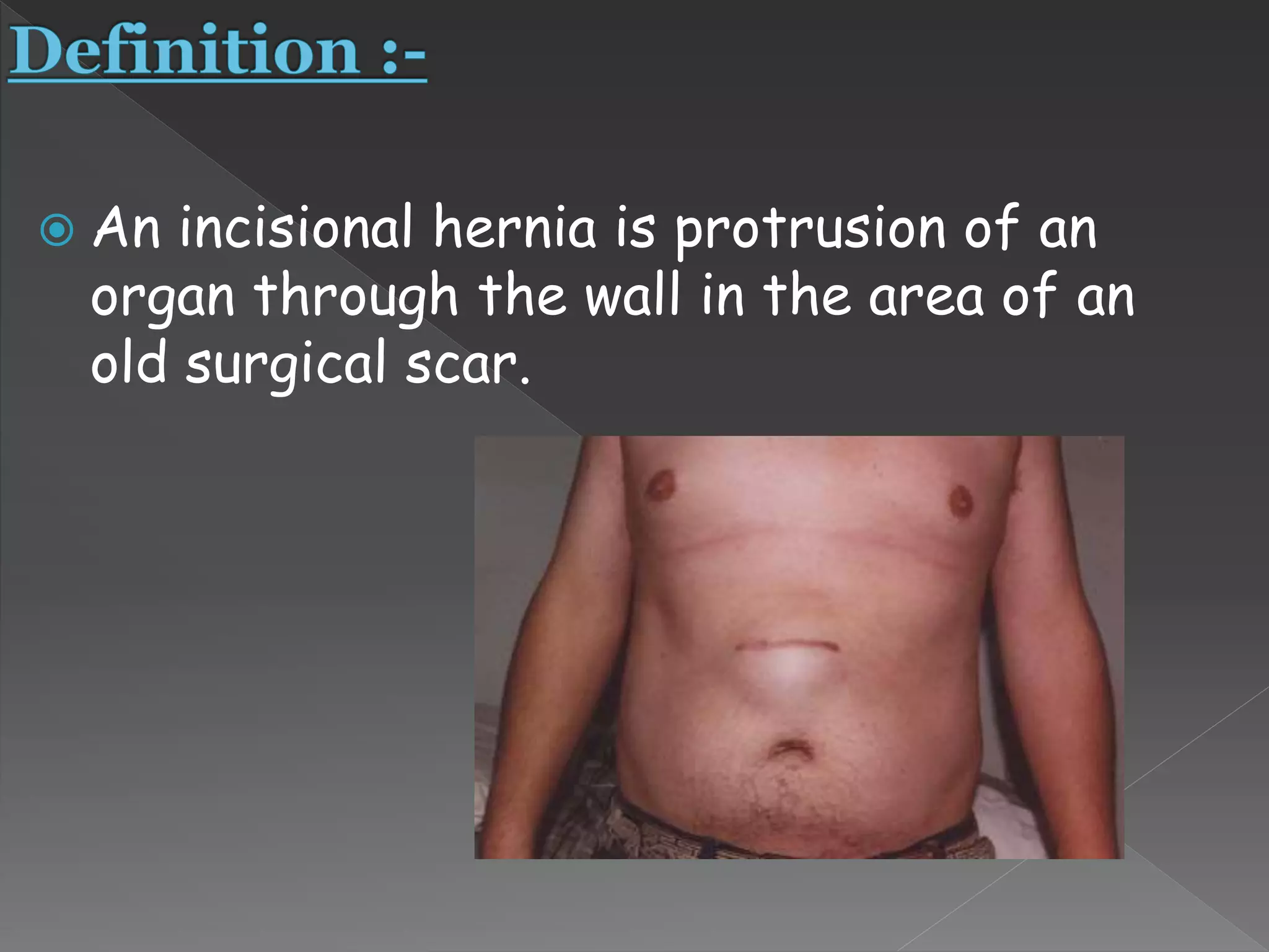 Incisional hernia | PPT