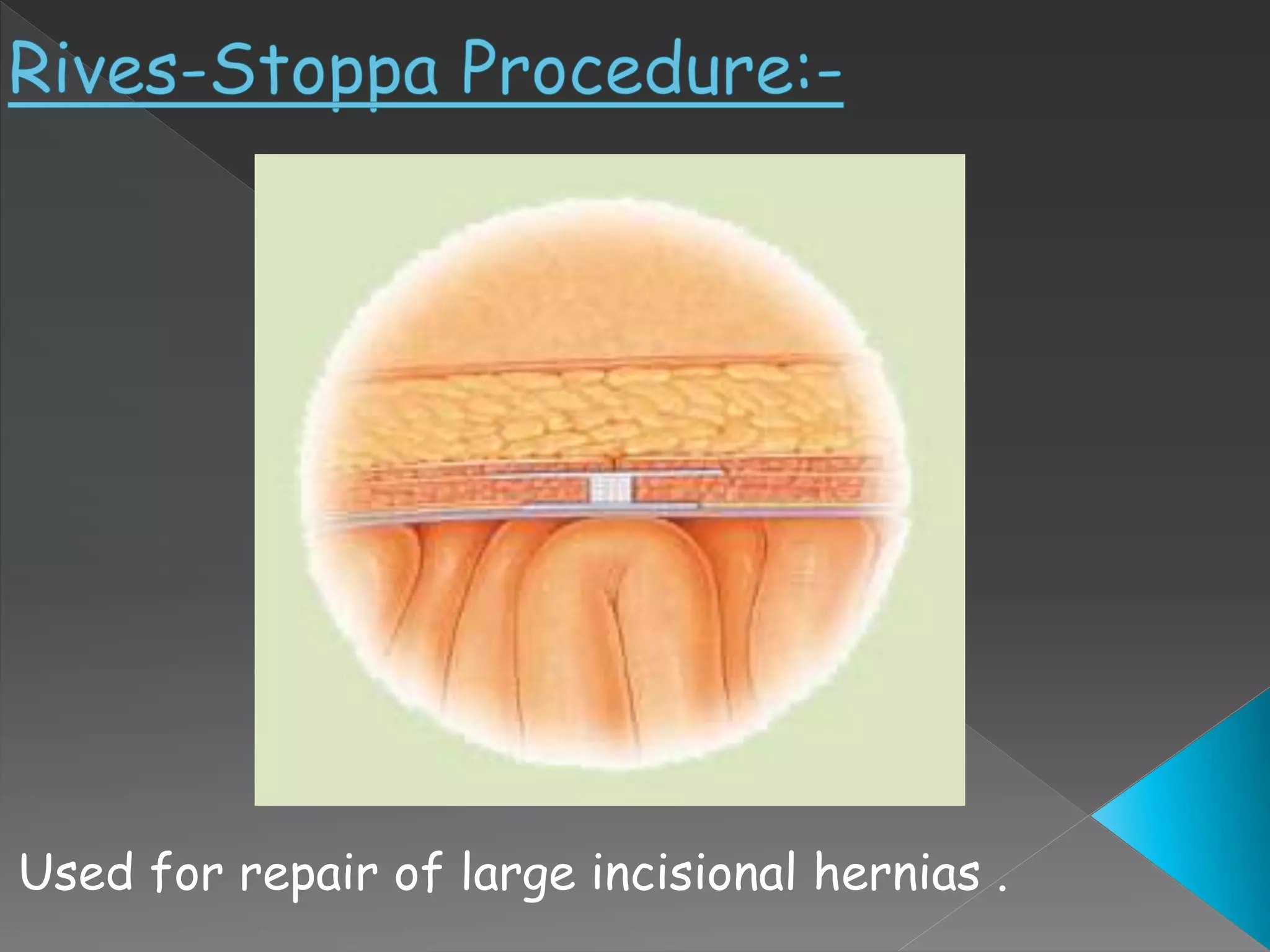 Incisional hernia | PPT