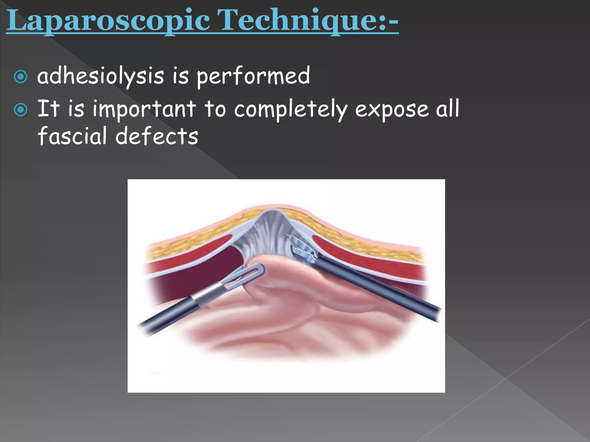 Incisional hernia | PPT