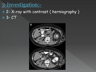 Incisional hernia | PPT