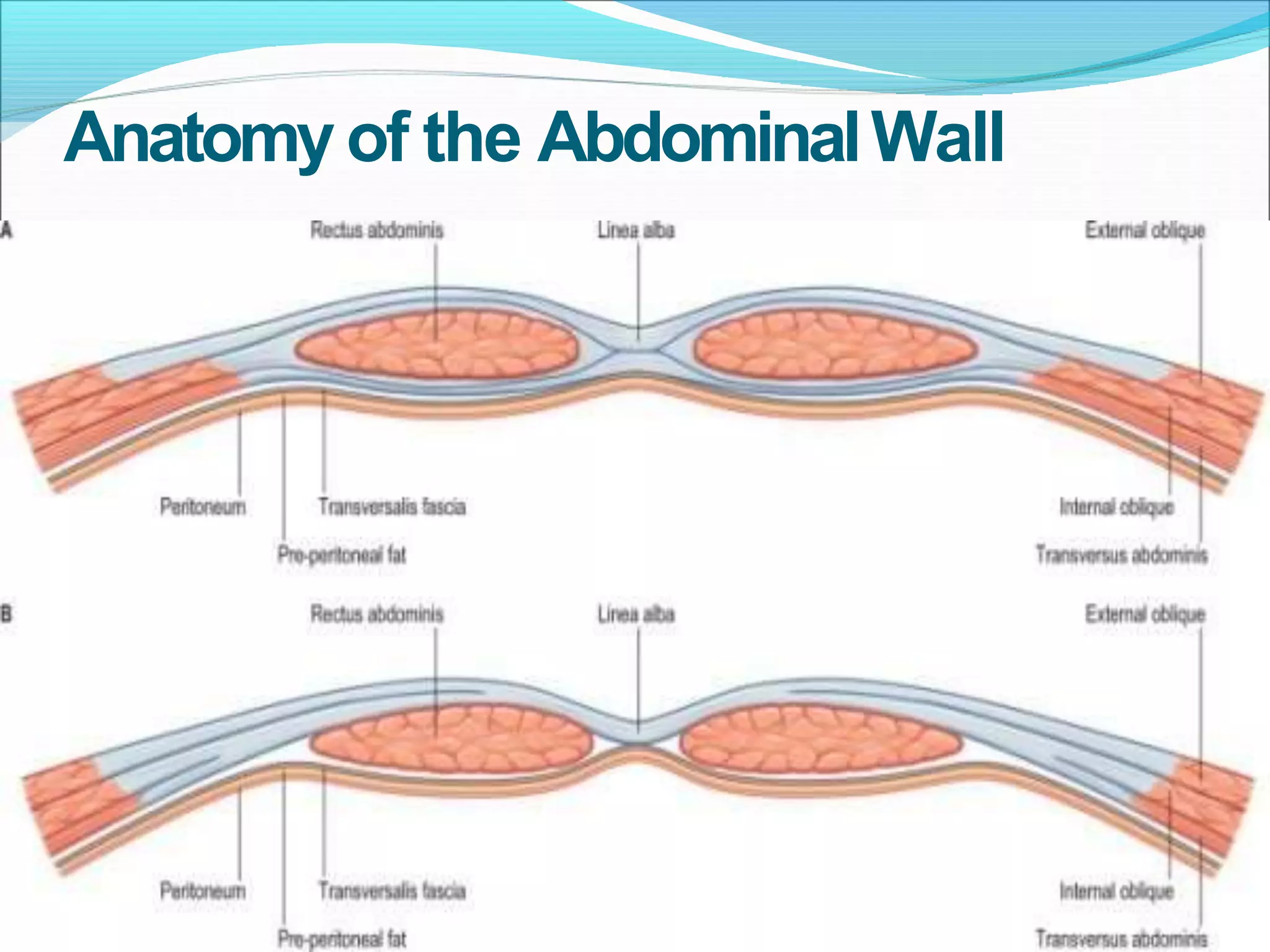Incisional hernia | PPTX