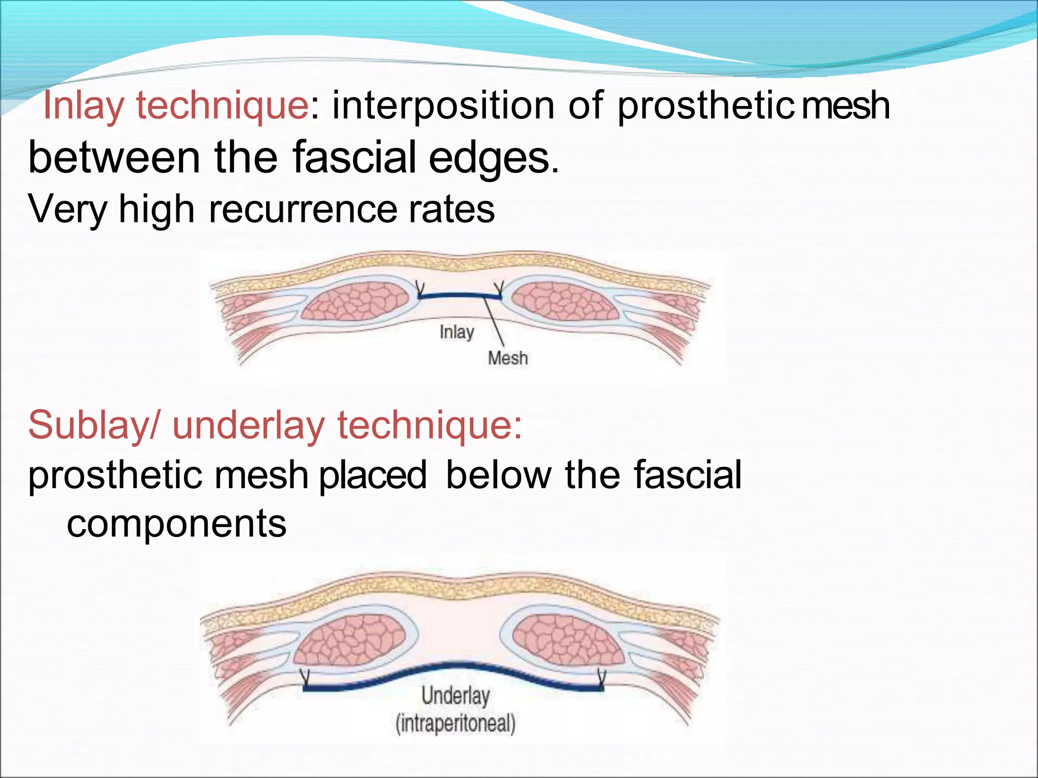 Incisional hernia | PPTX