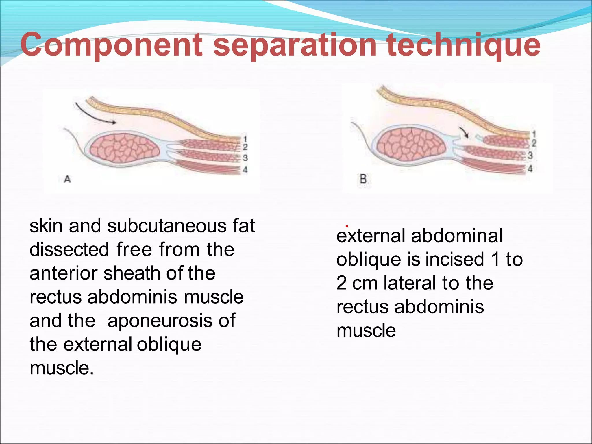 Incisional hernia | PPTX