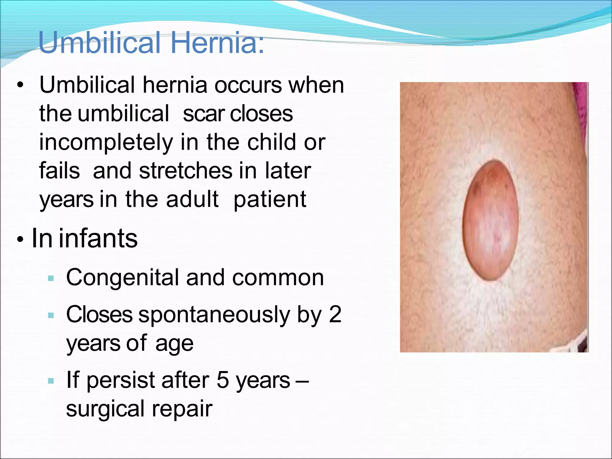 Incisional hernia | PPTX