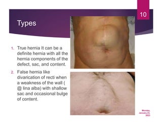 incisional hernia.ppt