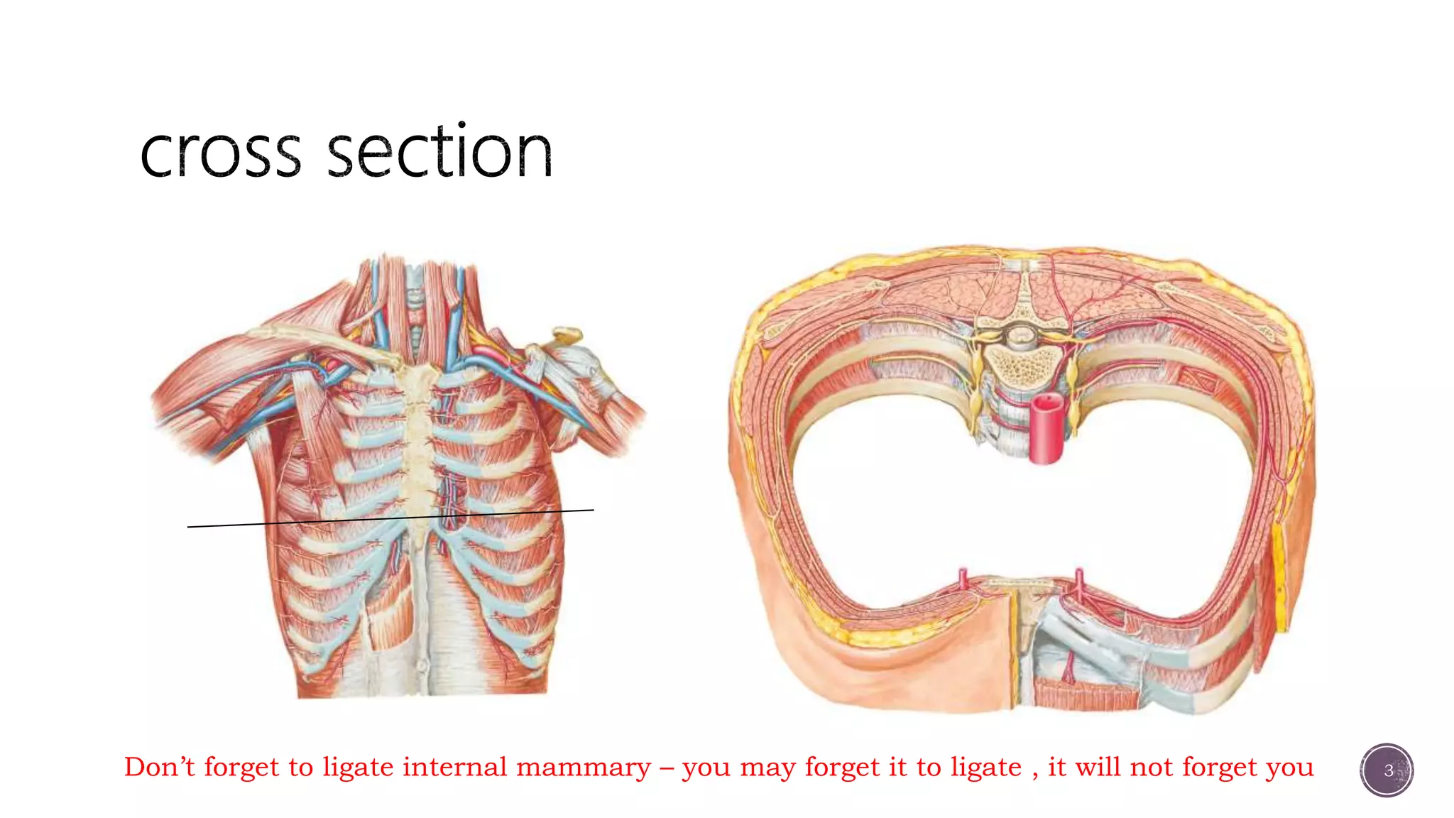 Incision and chest exposure in emergency | PPTX