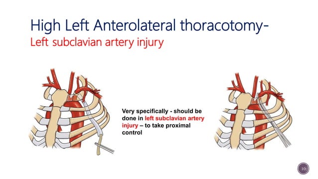 Incision and chest exposure in emergency | PPT
