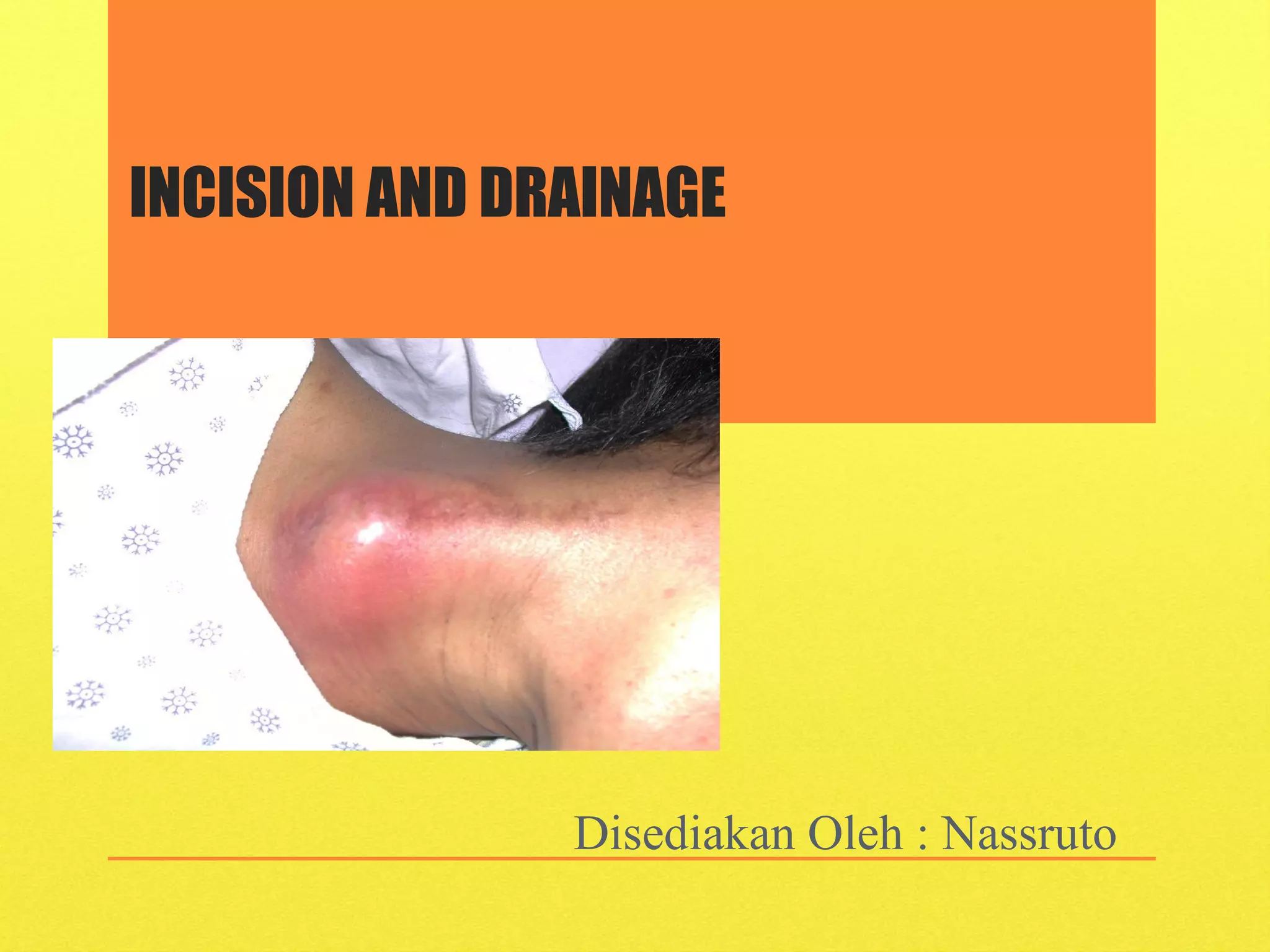 INCISION AND DRAINAGE | PPT