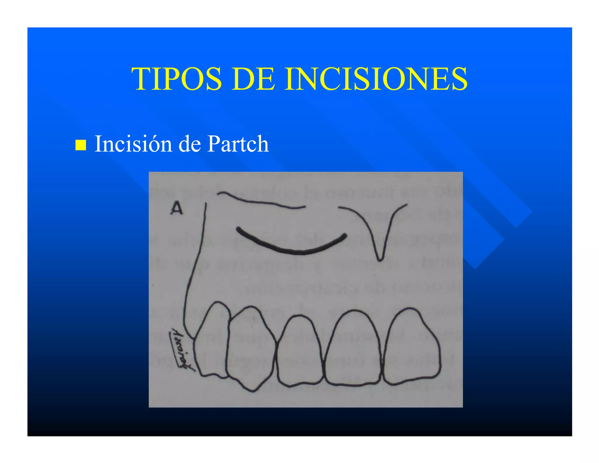 Incisiones De Colgajos | PDF