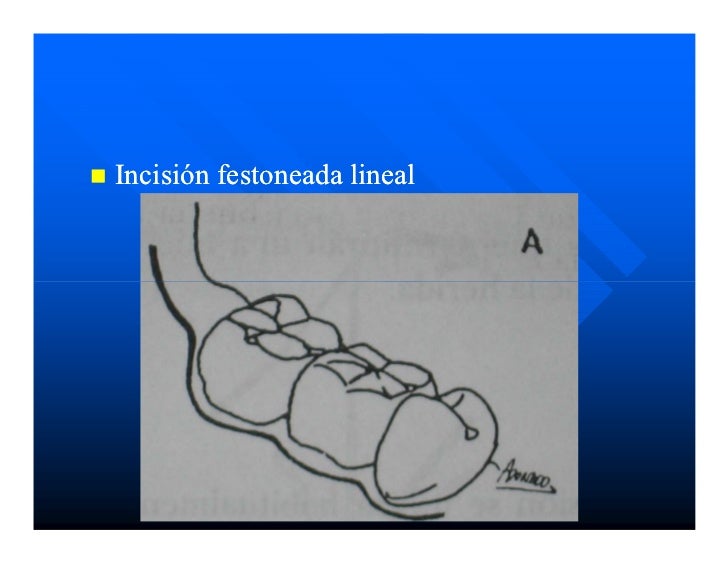 Incisiones De Colgajos