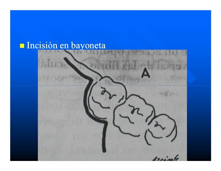 Incisiones De Colgajos