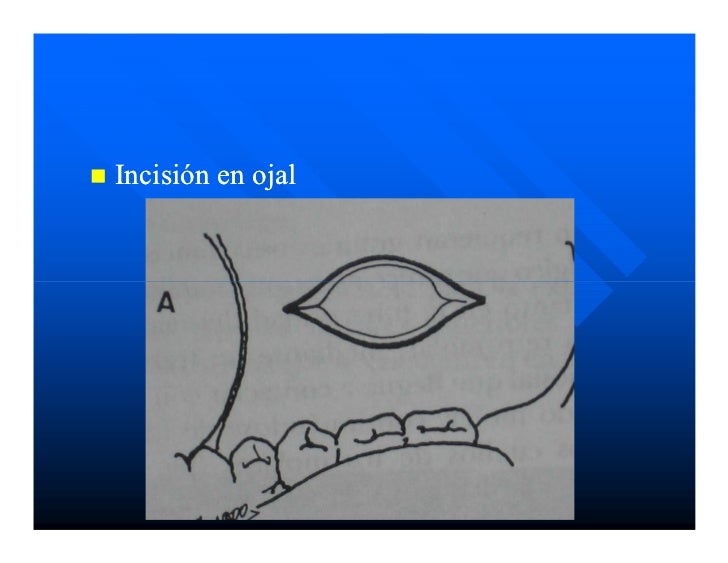 Incisiones De Colgajos