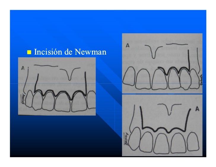 Incisiones De Colgajos