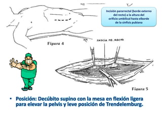 Incisiones abdominales | PPTX
