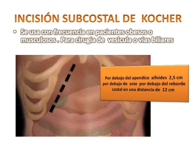Subcostal Incision