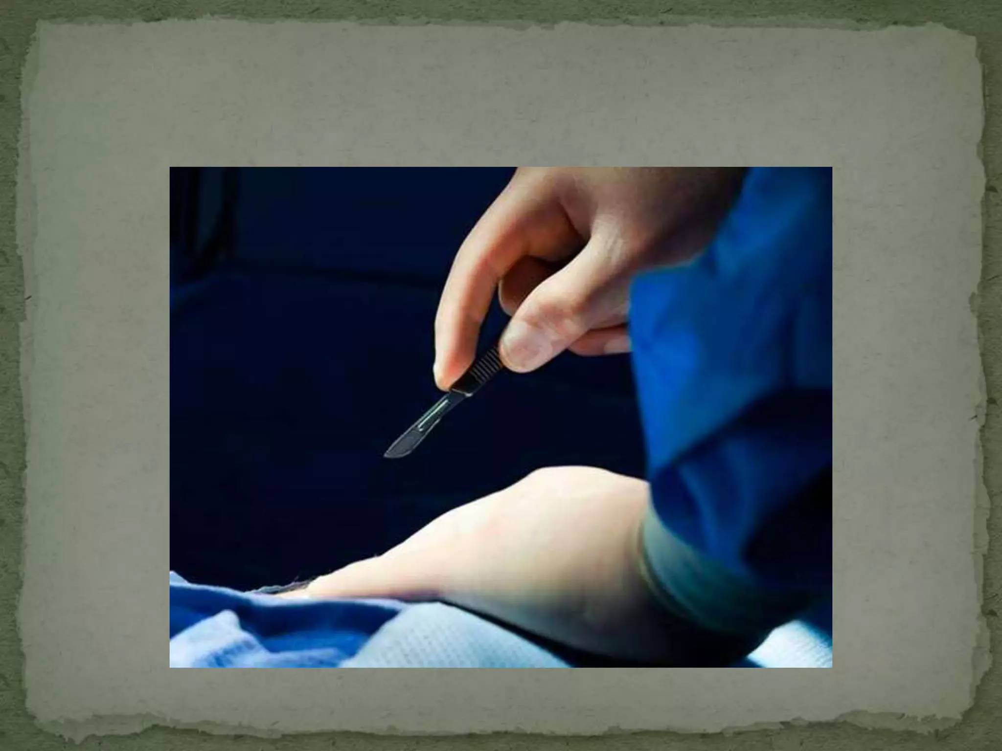 Incisiones quirurgícas Dr. Zama