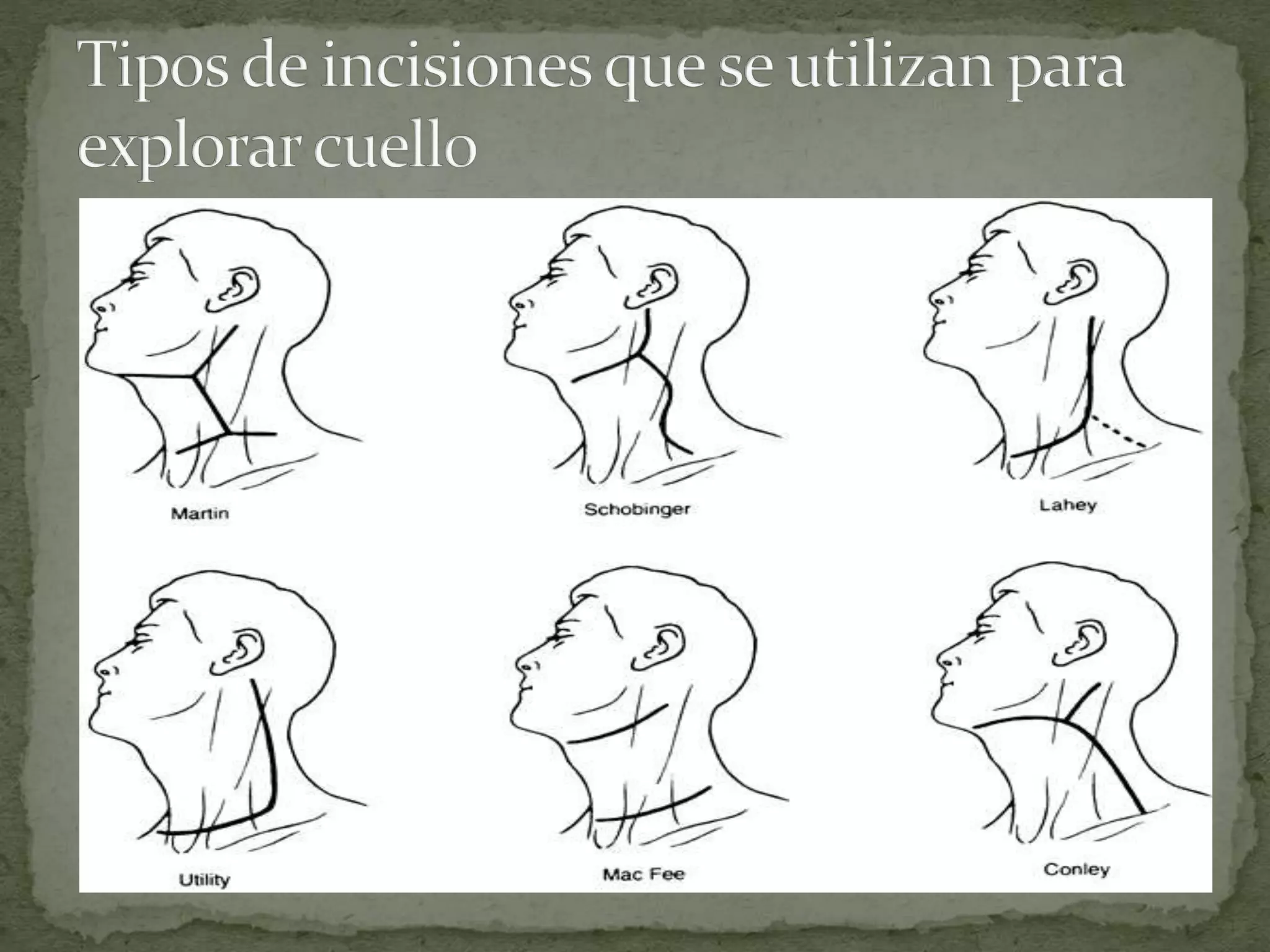 Incisiones quirurgícas Dr. Zama