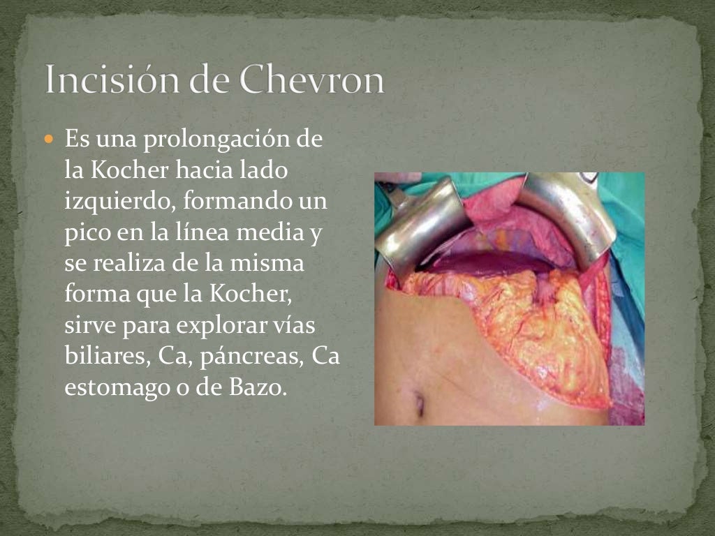 Incisiones quirurgícas Dr. Zama