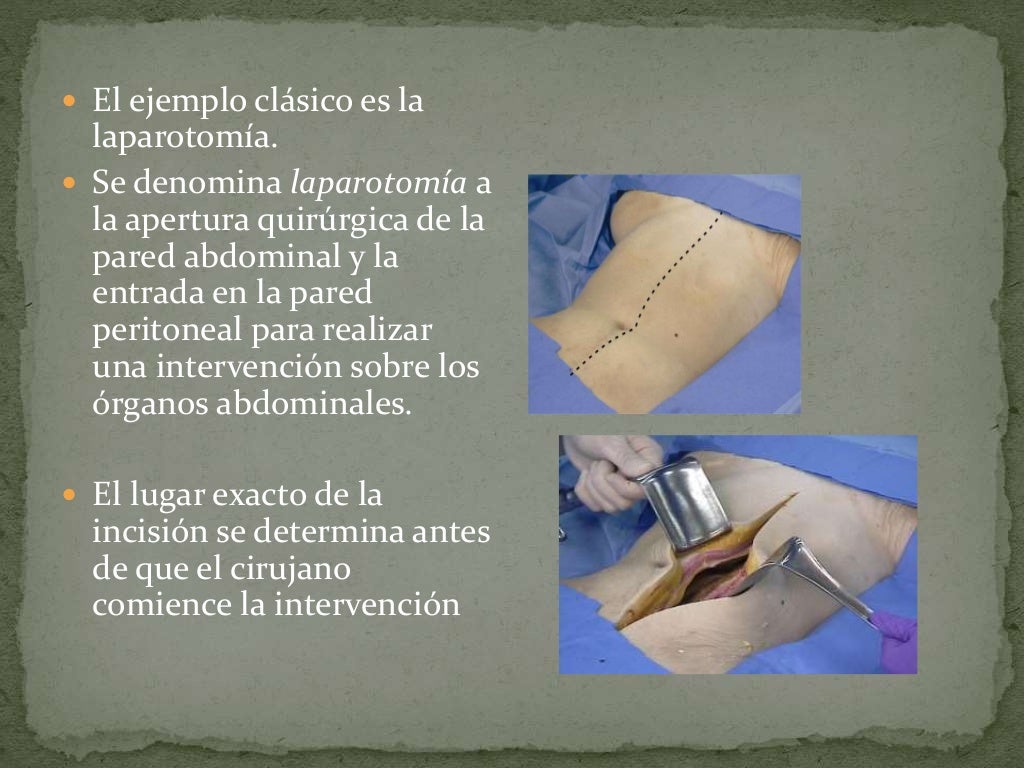 Incisiones quirurgícas Dr. Zama