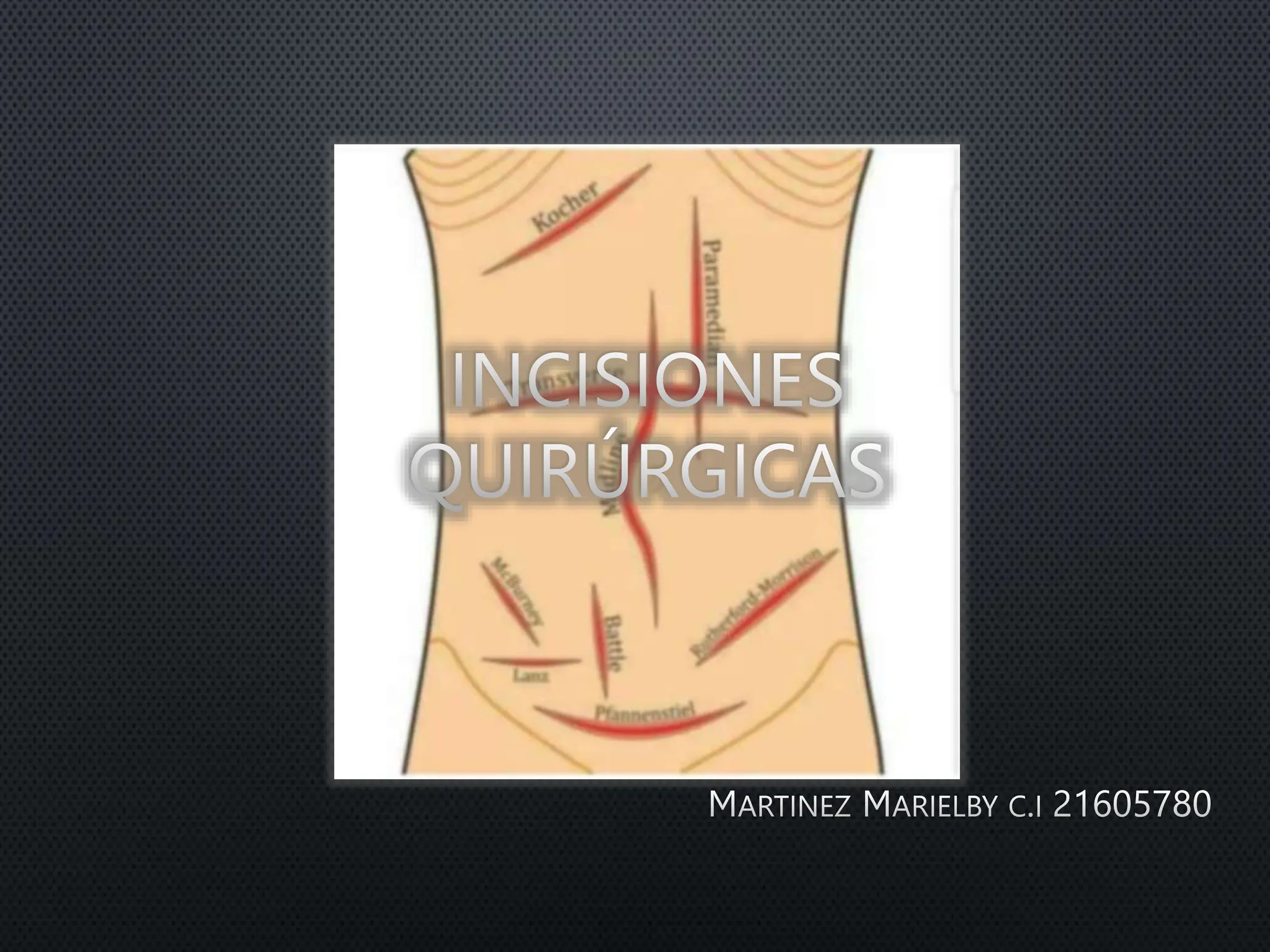 Incisiones quirúrgicas-1.pptxjjjjjjkjjjj | PPT