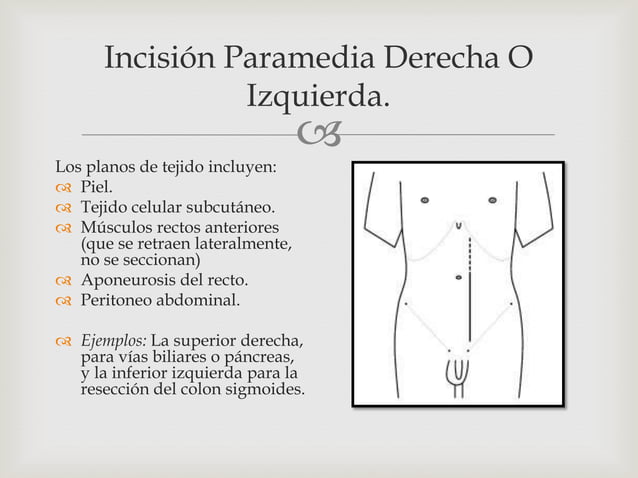 Incisiones quirúrgicas abdominales | PPTX