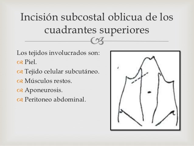 Subcostal Incision