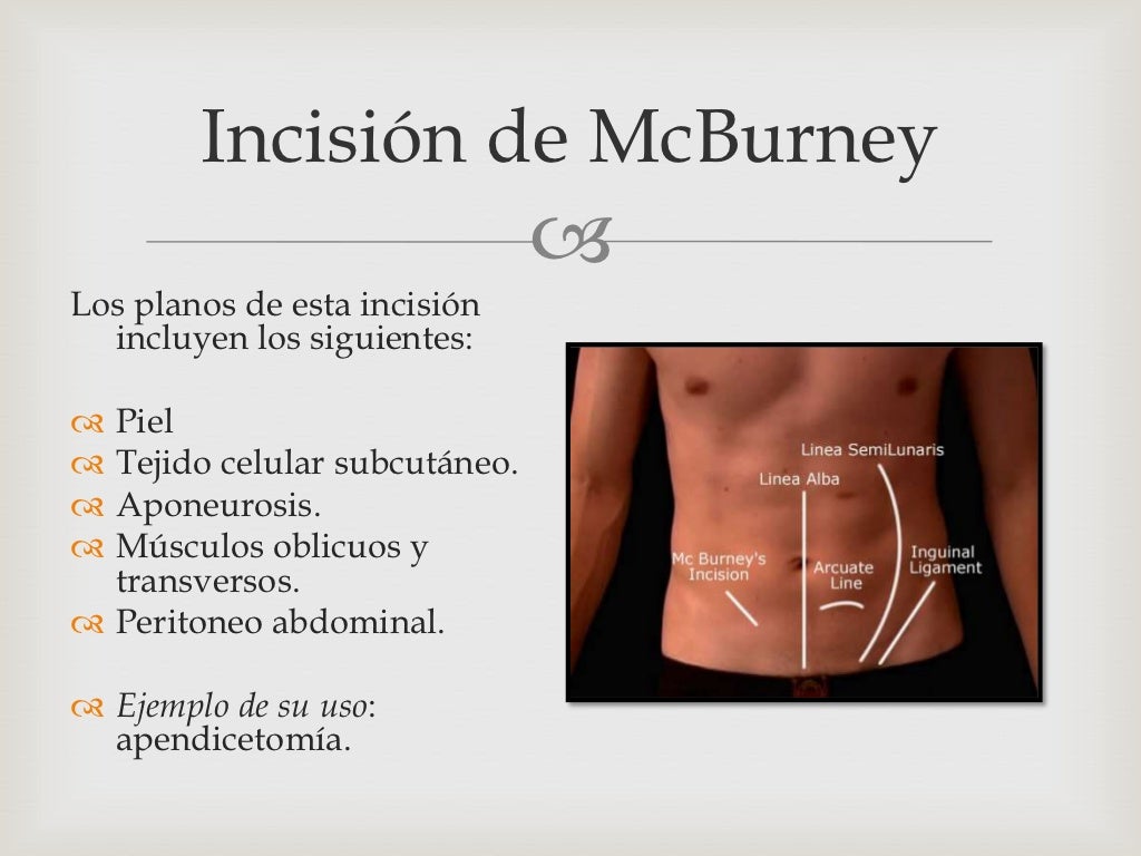 Incisiones quirúrgicas abdominales