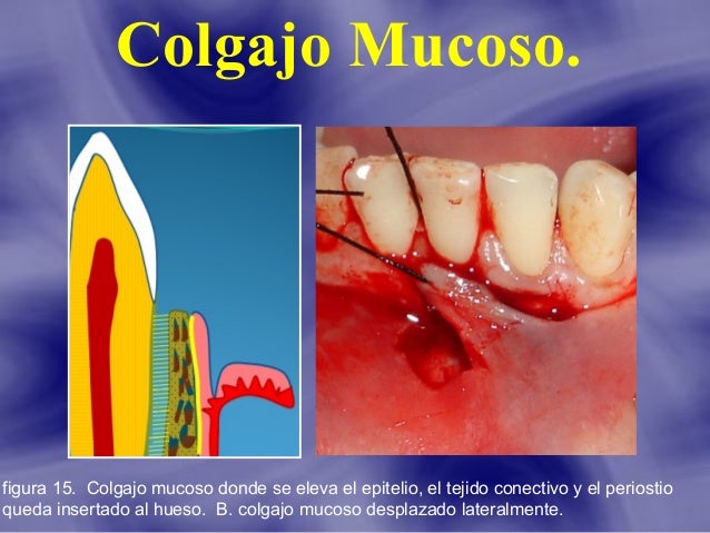 Incisiones y Colgajos