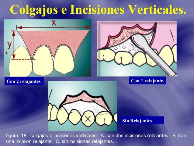Incisiones y Colgajos