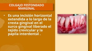 INCISIONES Y COLGAJOS EN ODONTOLOGÍA.pptx