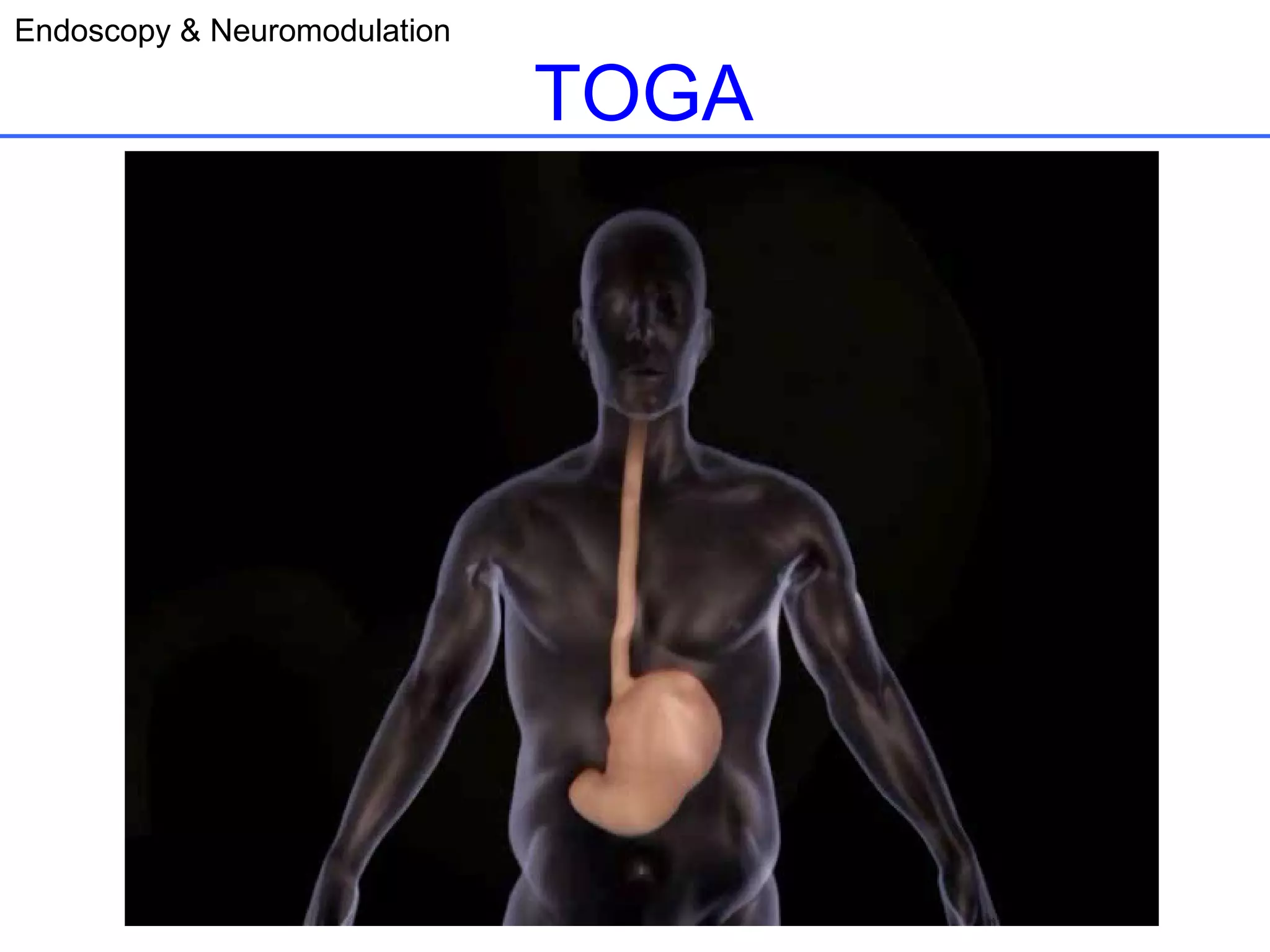 Incisionless procedures and stomach pacemaker for obesity | PPT