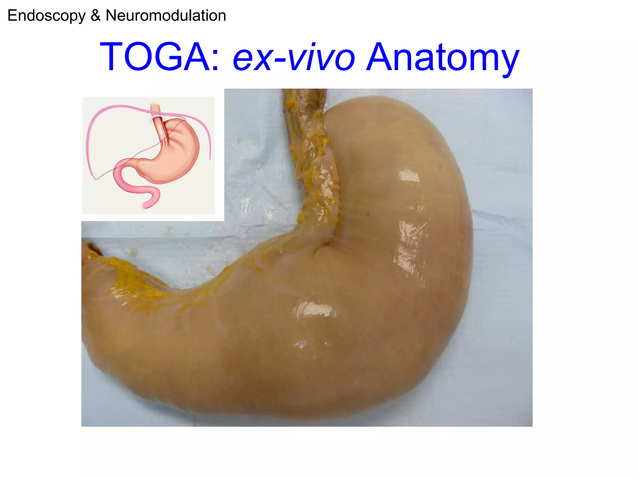 Incisionless procedures and stomach pacemaker for obesity | PPT
