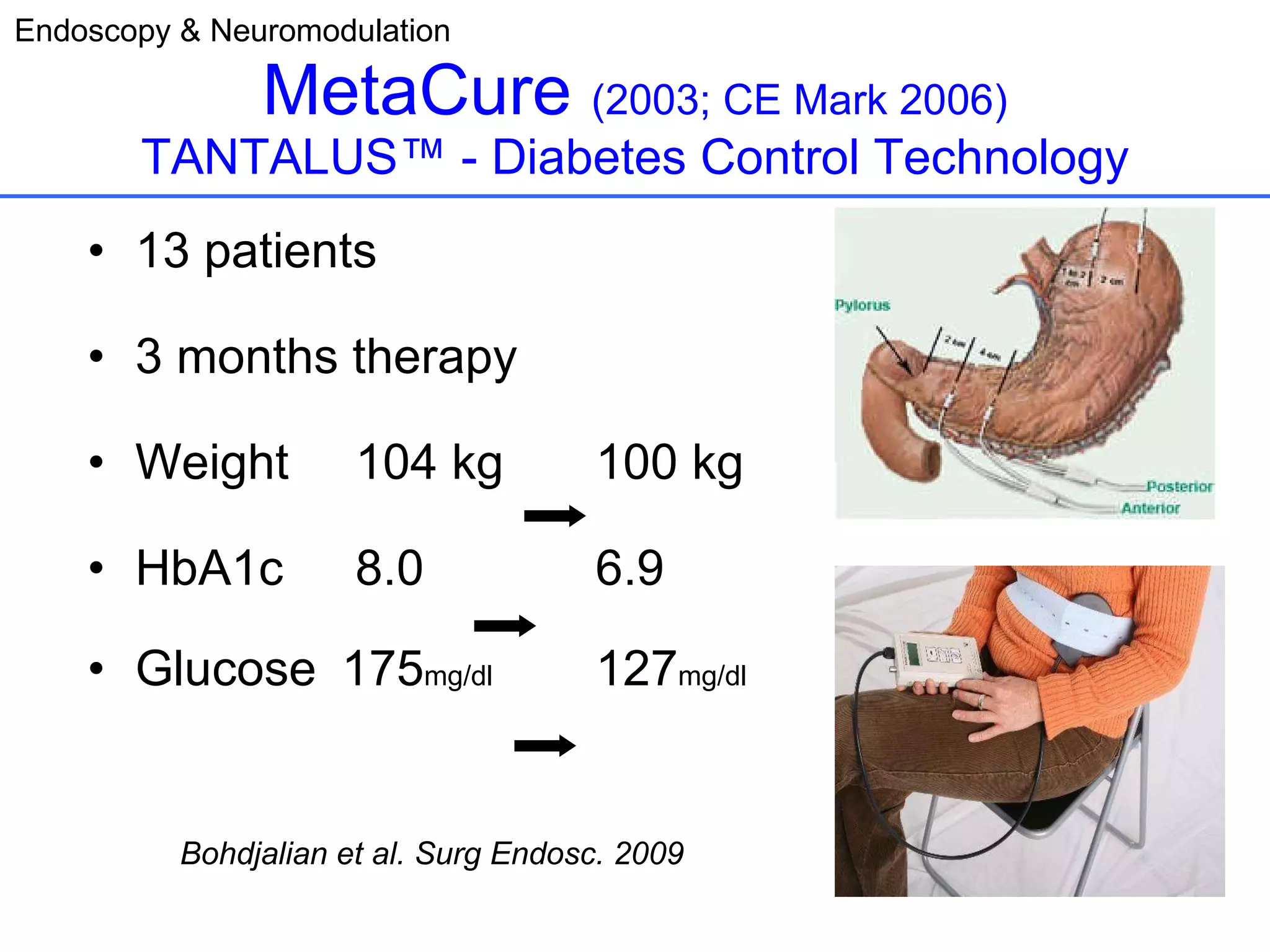 Incisionless procedures and stomach pacemaker for obesity | PPT