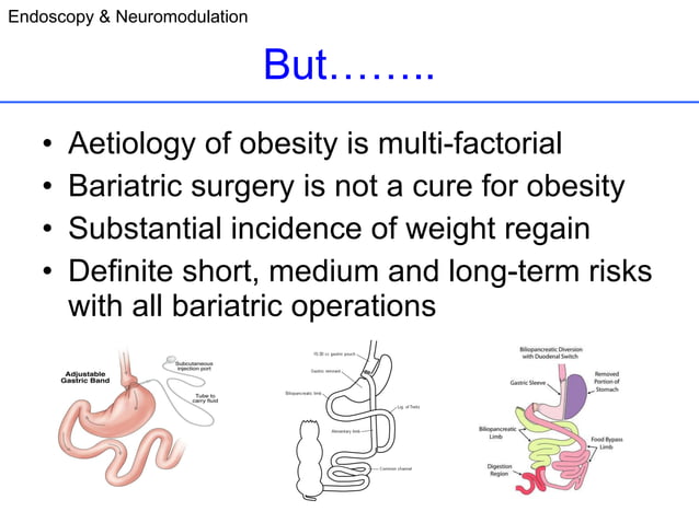 Incisionless procedures and stomach pacemaker for obesity | PPT