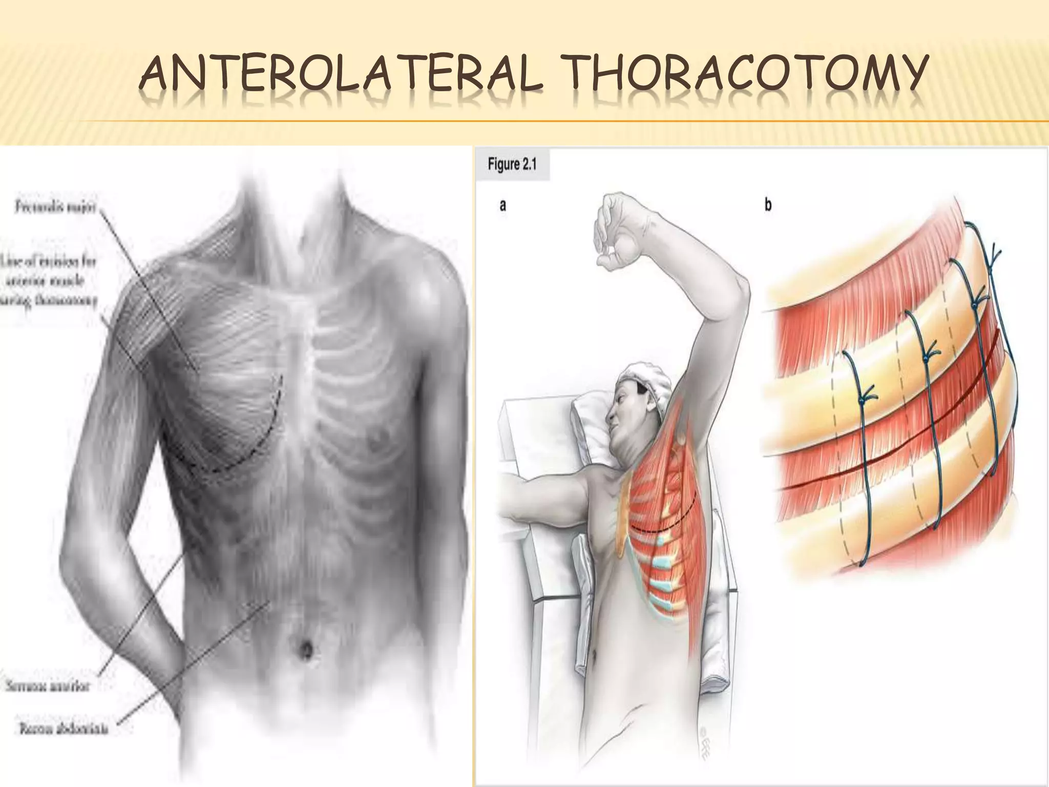 surgical Incisions - sadeghi mazloumi | PPTX