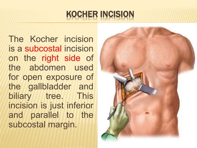 surgical Incisions - sadeghi mazloumi | PPT