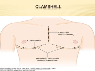 Clamshell Incision
