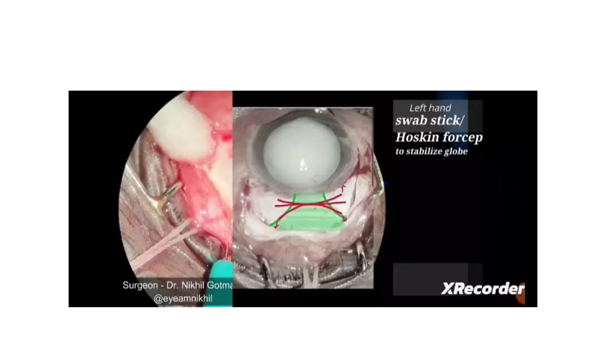 INCISIONS IN CATARACT SURGERY.pptx