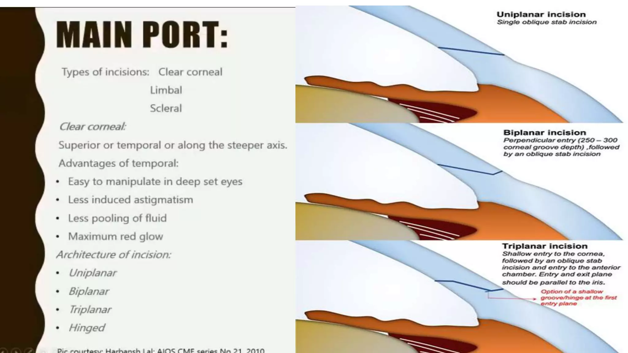INCISIONS IN CATARACT SURGERY.pptx