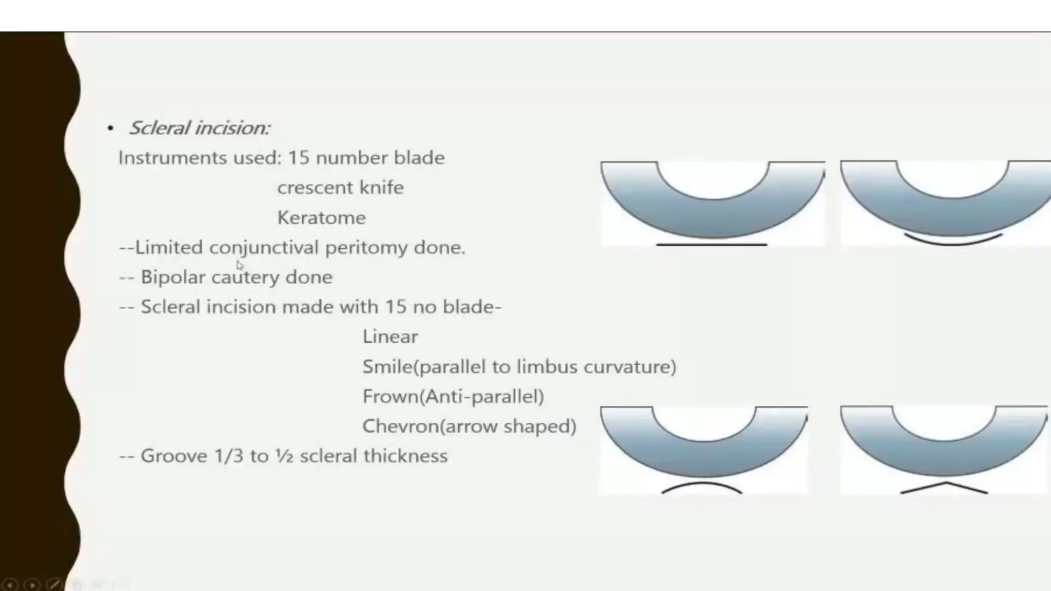 INCISIONS IN CATARACT SURGERY.pptx
