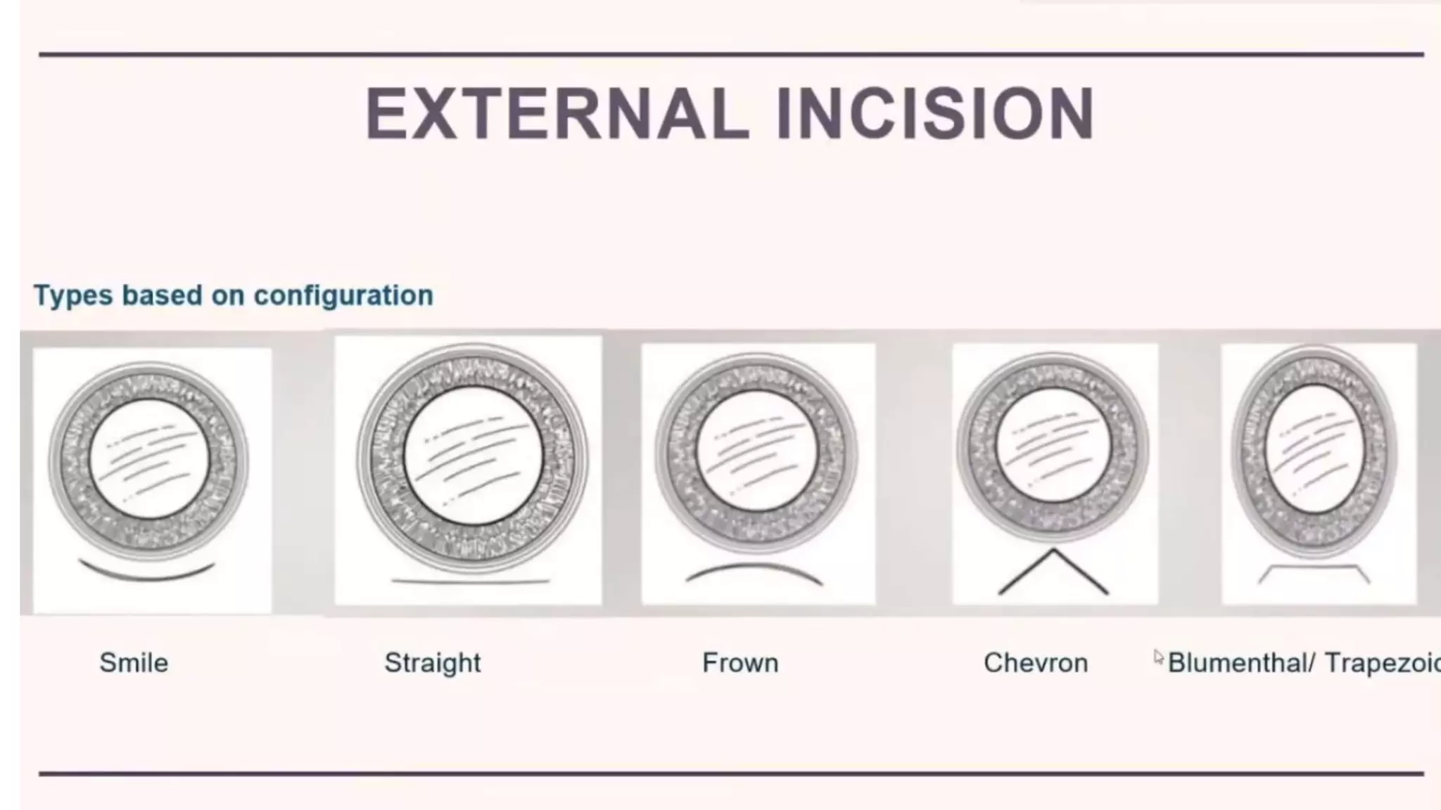 INCISIONS IN CATARACT SURGERY.pptx