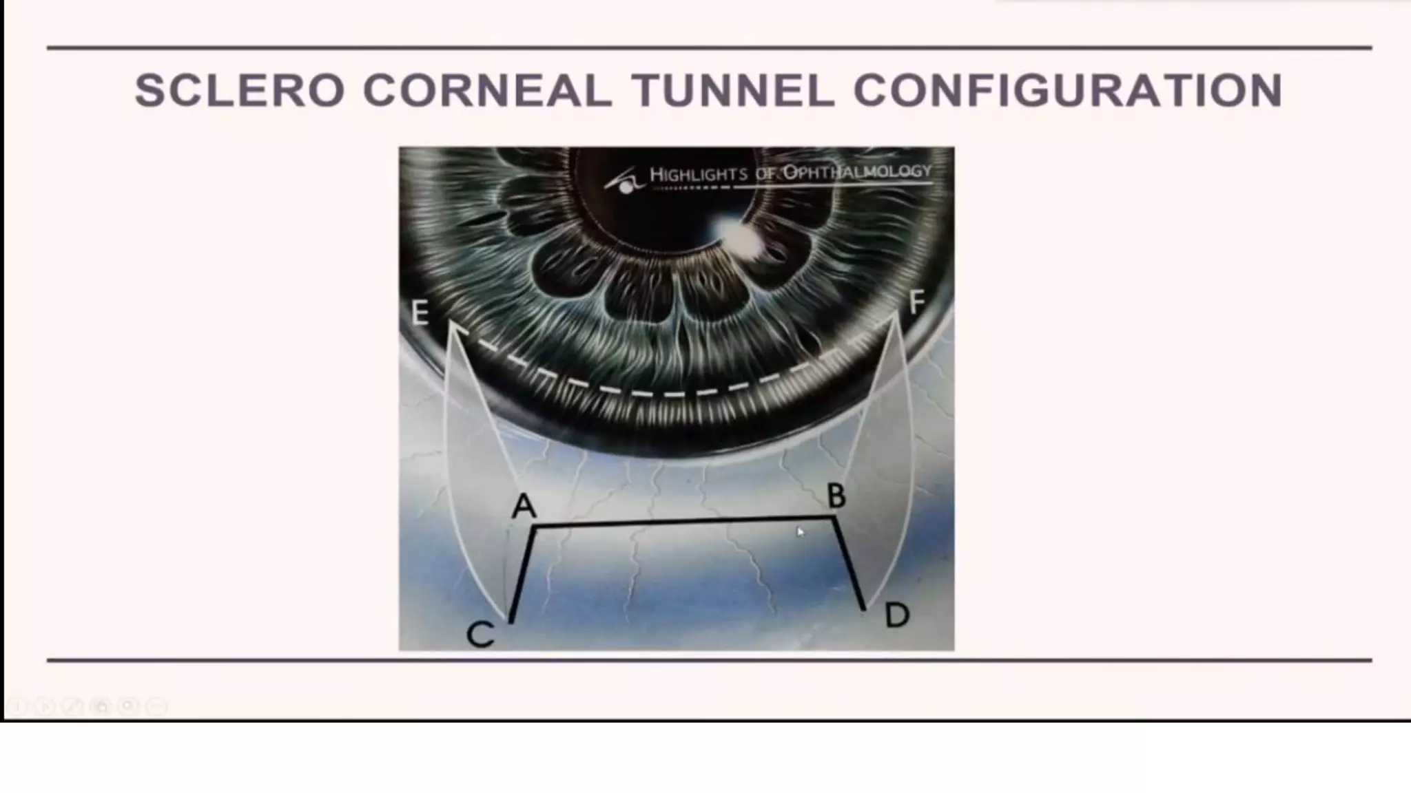 INCISIONS IN CATARACT SURGERY.pptx
