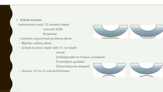 INCISIONS IN CATARACT SURGERY.pptx