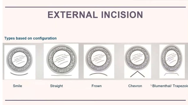 INCISIONS IN CATARACT SURGERY.pptx