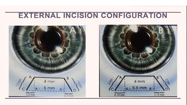 INCISIONS IN CATARACT SURGERY.pptx