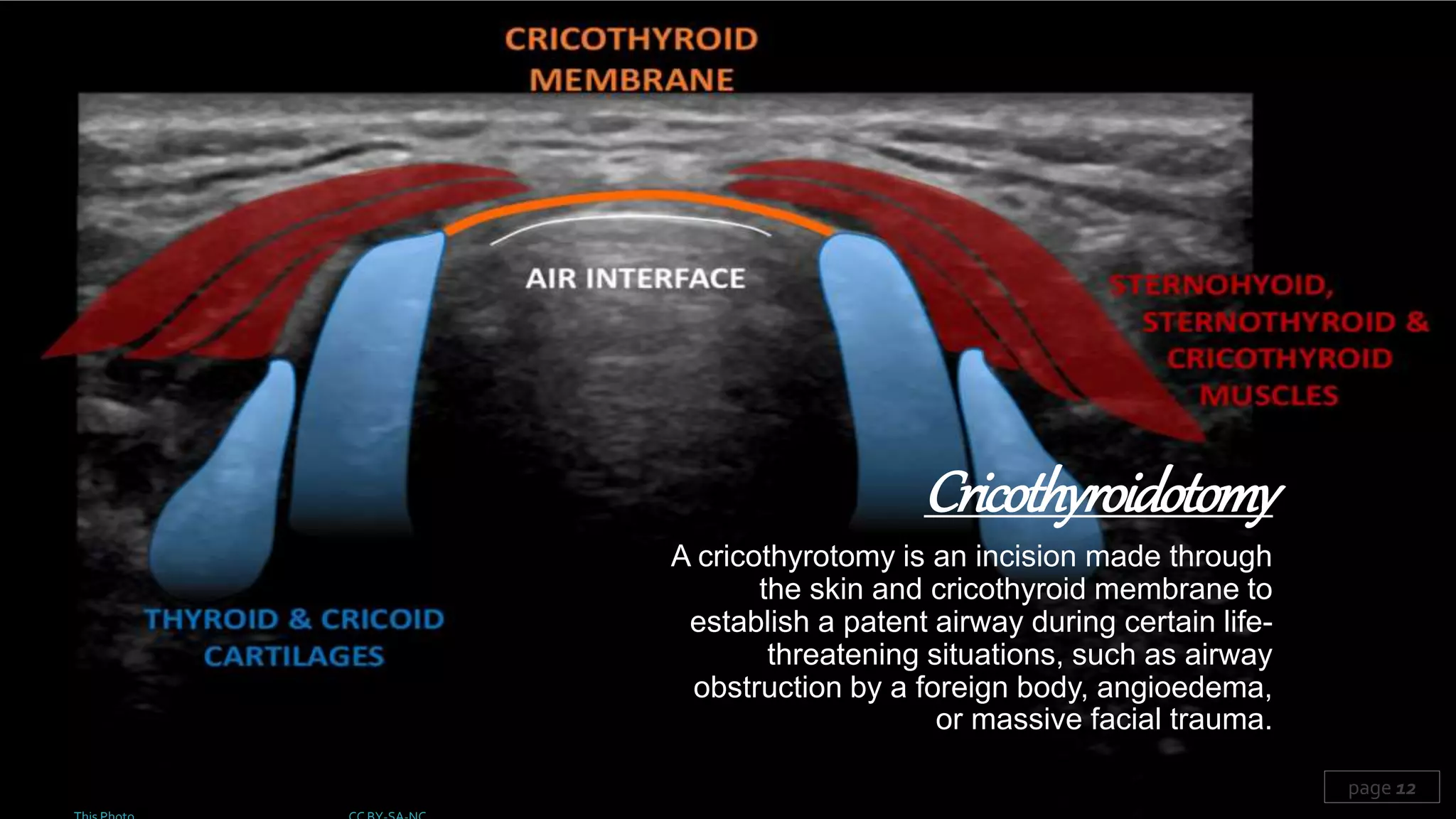 Incisions in the neck, thyroidectomy, parathyroidectomy | PPTX