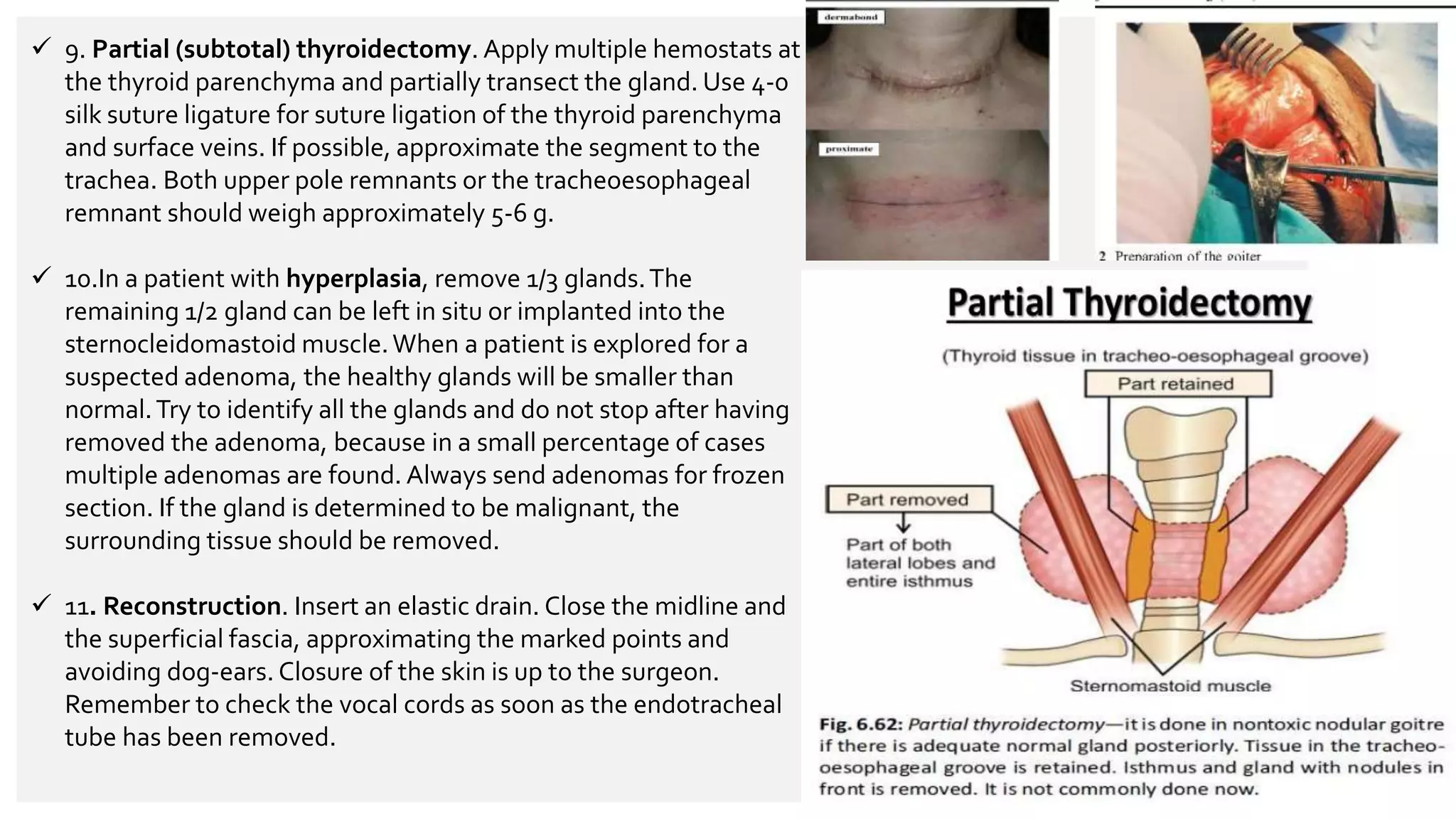 Incisions in the neck, thyroidectomy, parathyroidectomy | PPTX