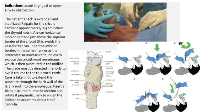 Incisions in the neck, thyroidectomy, parathyroidectomy | PPTX