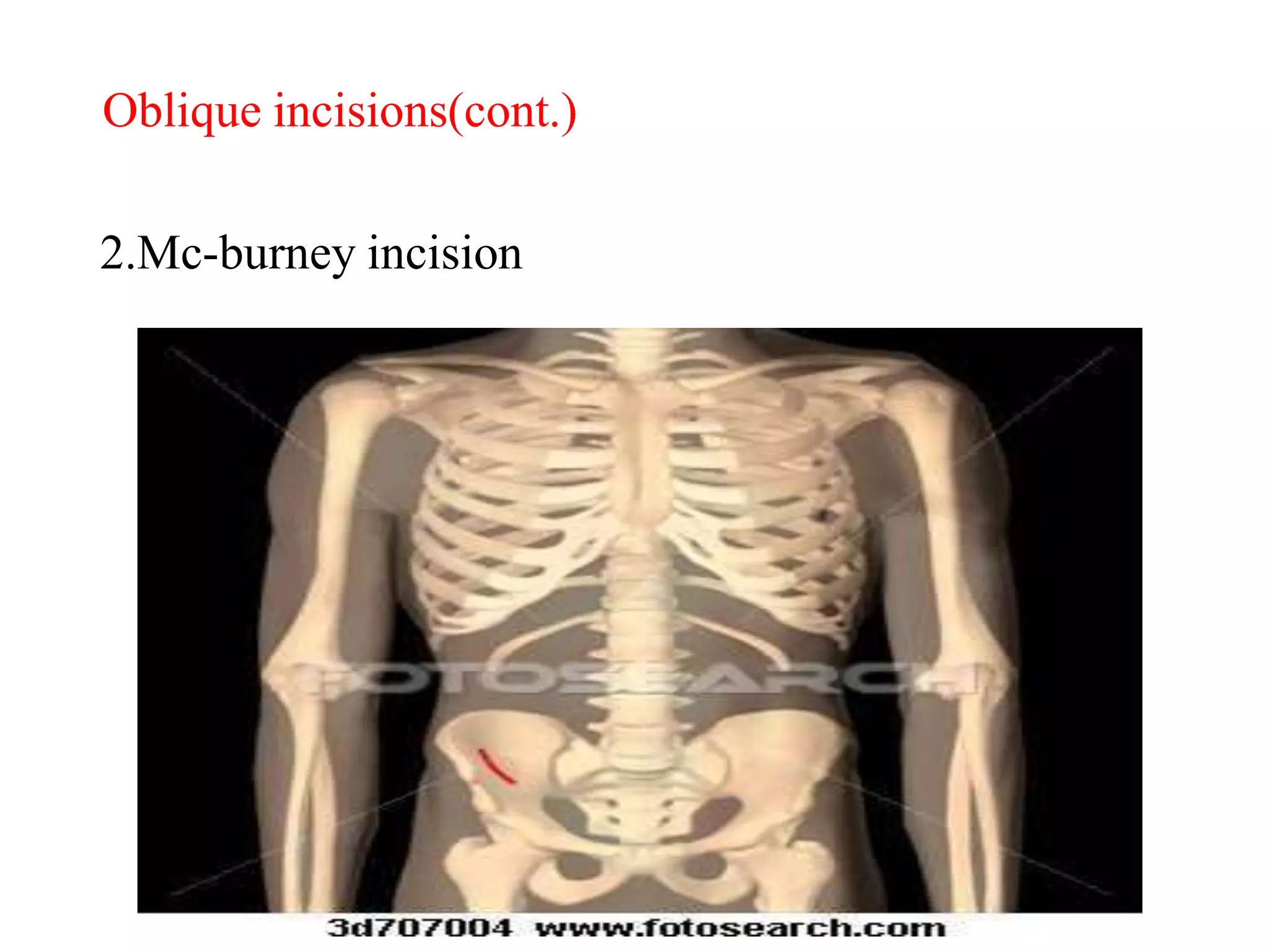 Abdominal incision | PPTX