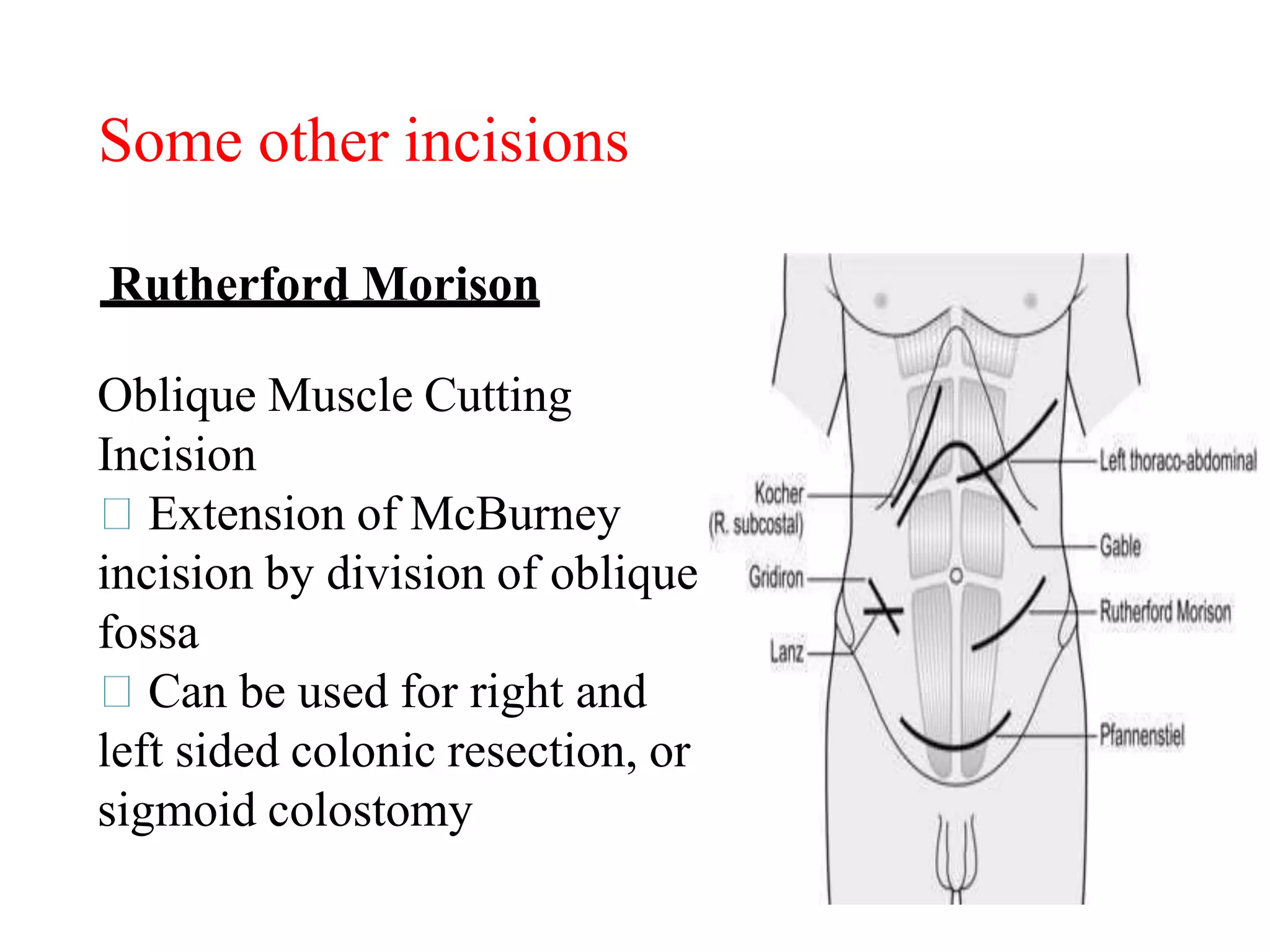 Abdominal incision | PPTX
